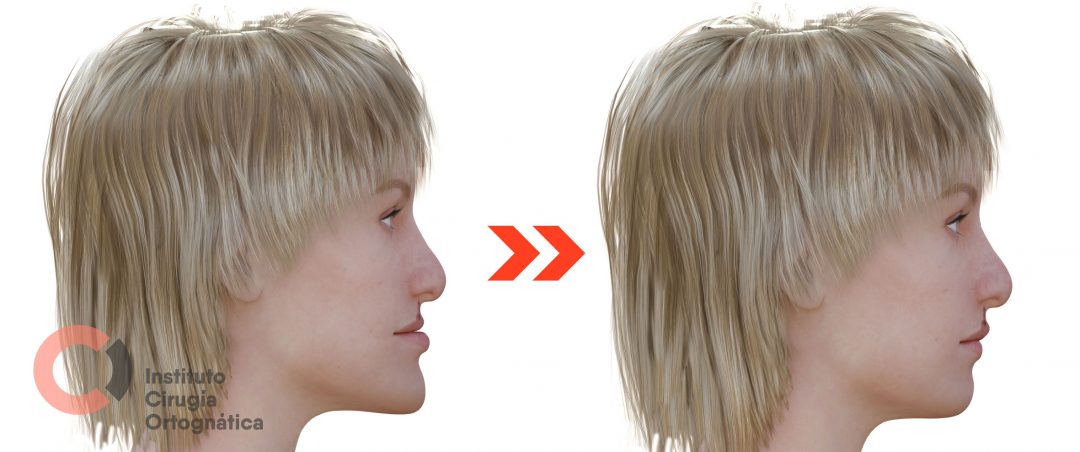 Labio leporino o fisurado: qué es y tratamiento - Instituto cirugía ...